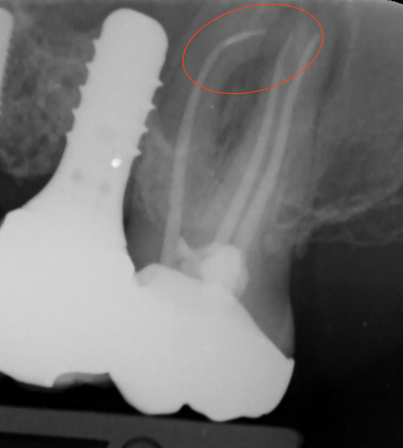 Removing broken endo files using Ultrasonics