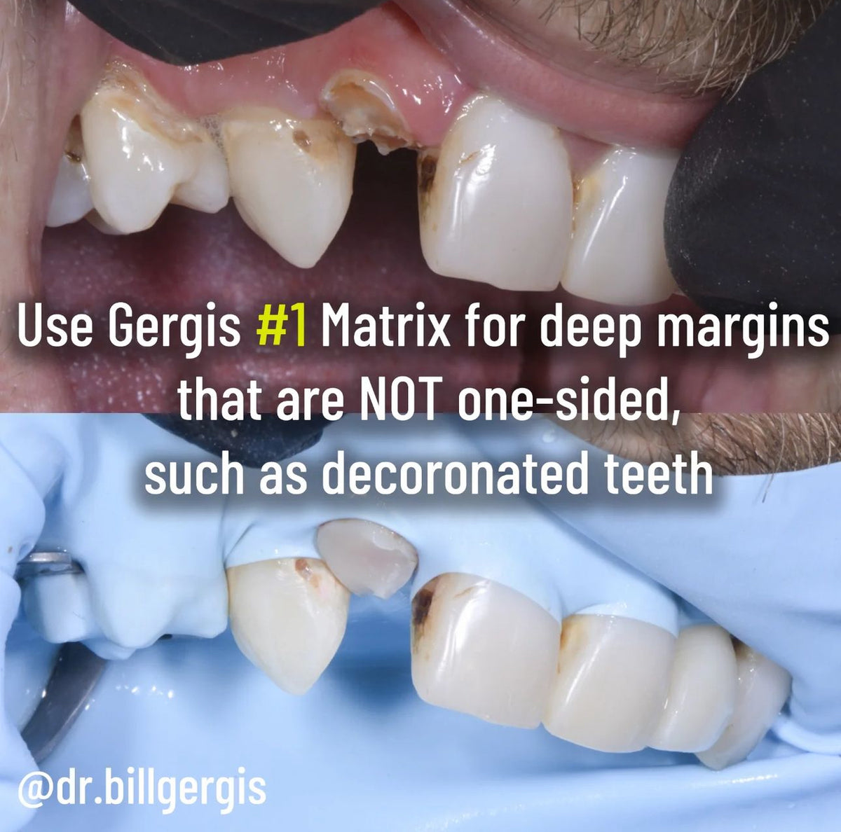 Gergis and Tofflemire metal matrix bands